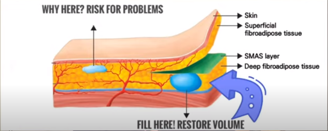 Why displaced or bruised after filling tear troughs - Dermax