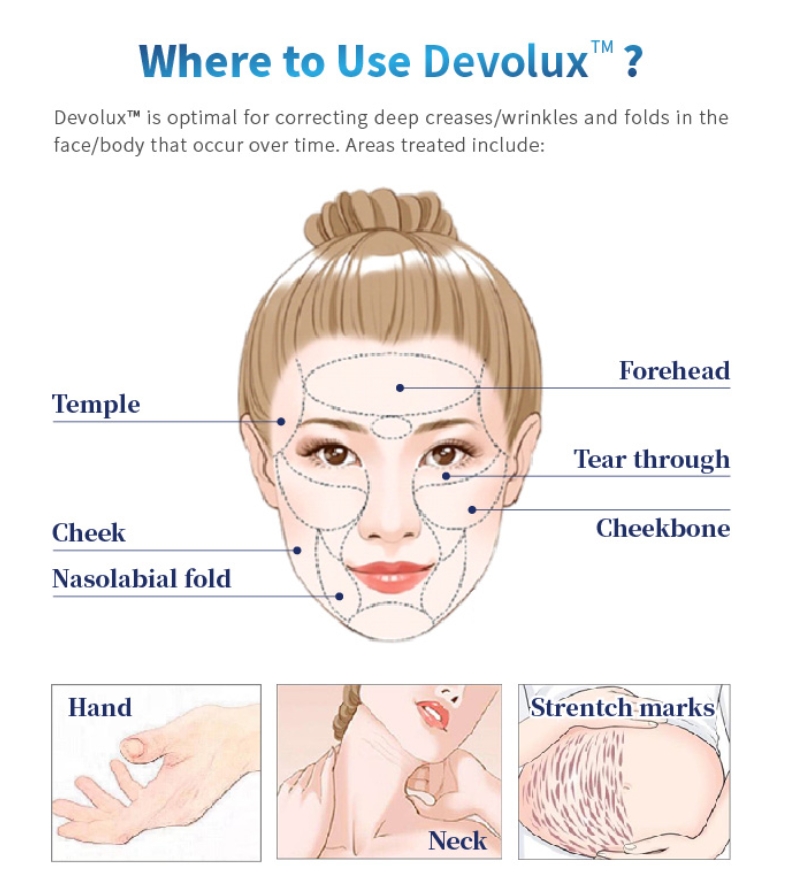 Devolux Filler injectable poly l lactic acid - Dermax